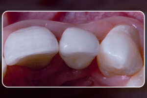Prótese sobre implante: parafusada ou cimentada? - Revista ImplantNews