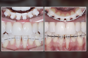 Manejo cirúrgico e ortodôntico de recessões gengivais em incisivos ...