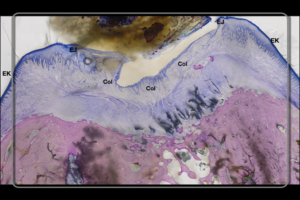 Área do COL: a região do “vale” interproximal - Revista ImplantNews
