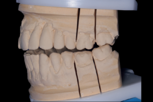 Previsibilidade para ajuste oclusal por desgaste seletivo - Revista ...
