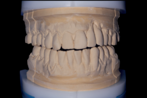 Previsibilidade para ajuste oclusal por desgaste seletivo - Revista ...